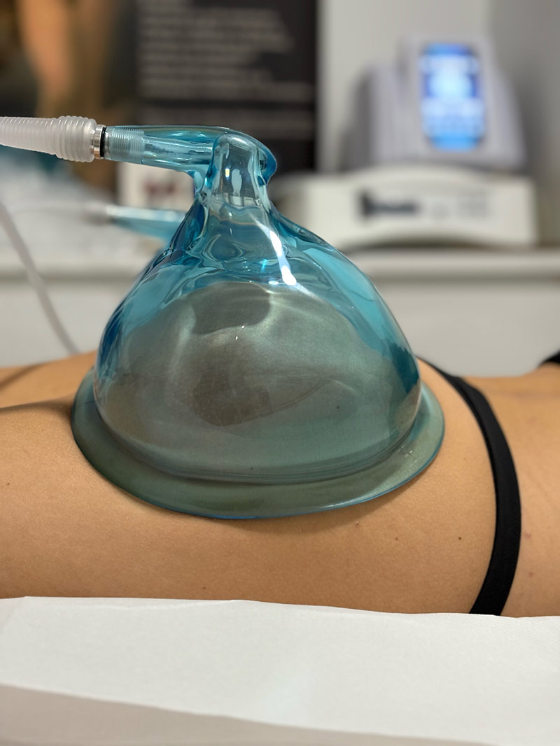 Vacumterapia de glúteos en Madrid - Estefania Ariza
